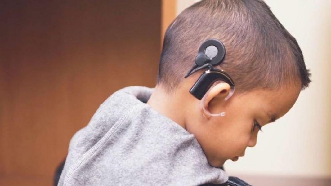 Sinaloa coloca 59 implantes cocleares y elimina la lista de espera – Mi ...